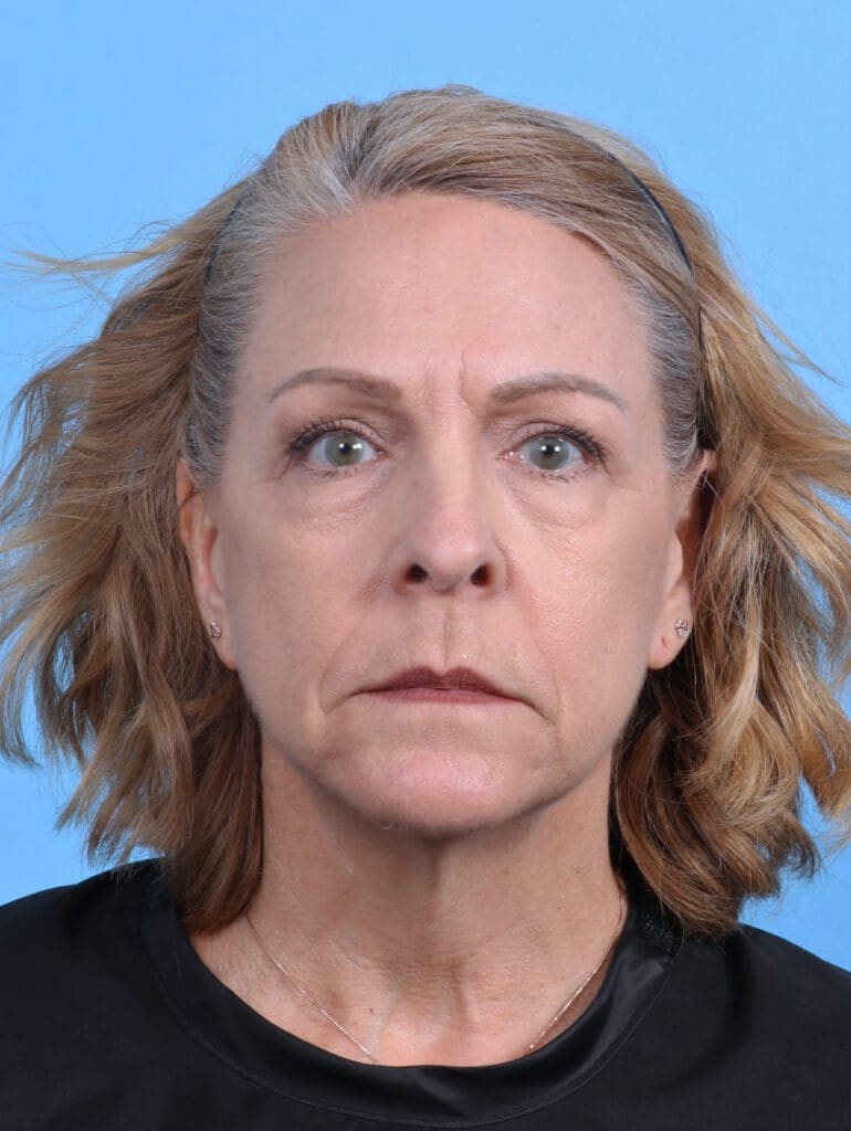 Eyelid Surgery Before and After Photo Gallery | Folsom, CA